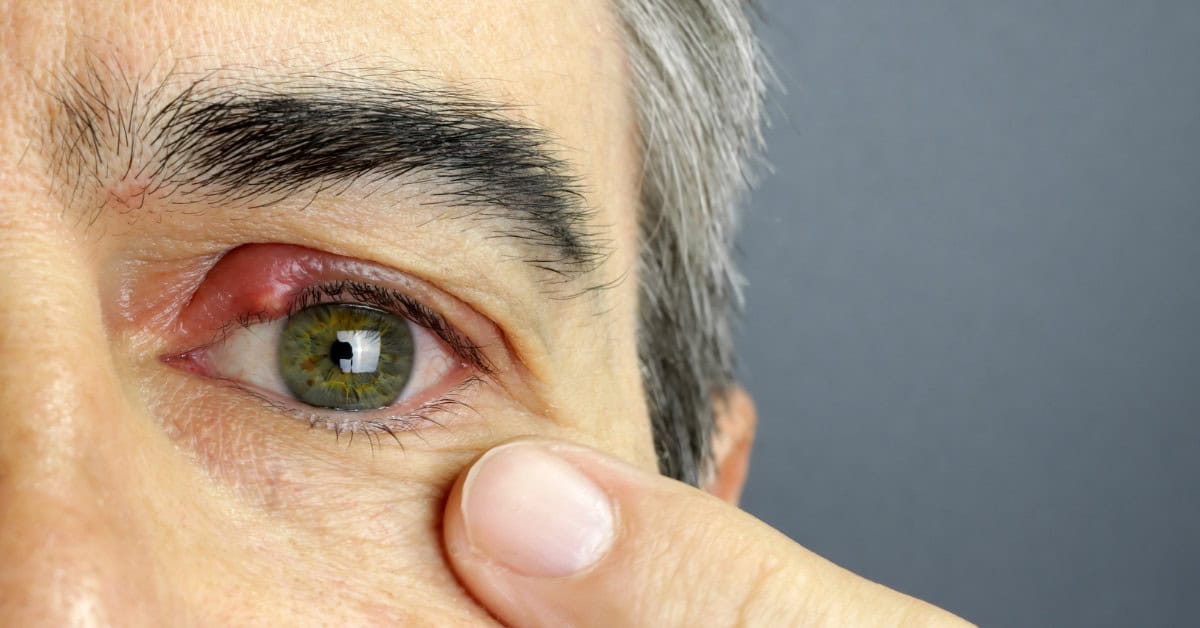 ¿Qué es un Orzuelo y Cómo Tratarlo? - Dra. Alba García - Oculoplástica ...
